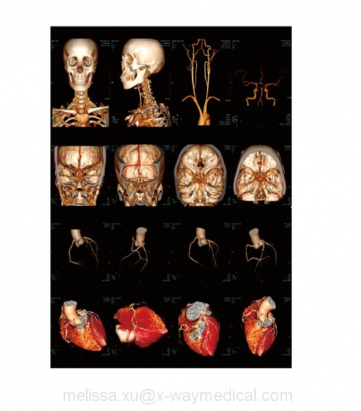 Hospital DR CR CT MRI DSA dry Thermal X-ray film, PET films for Agfa 5302 Fuji drypix 2000 3500 ...